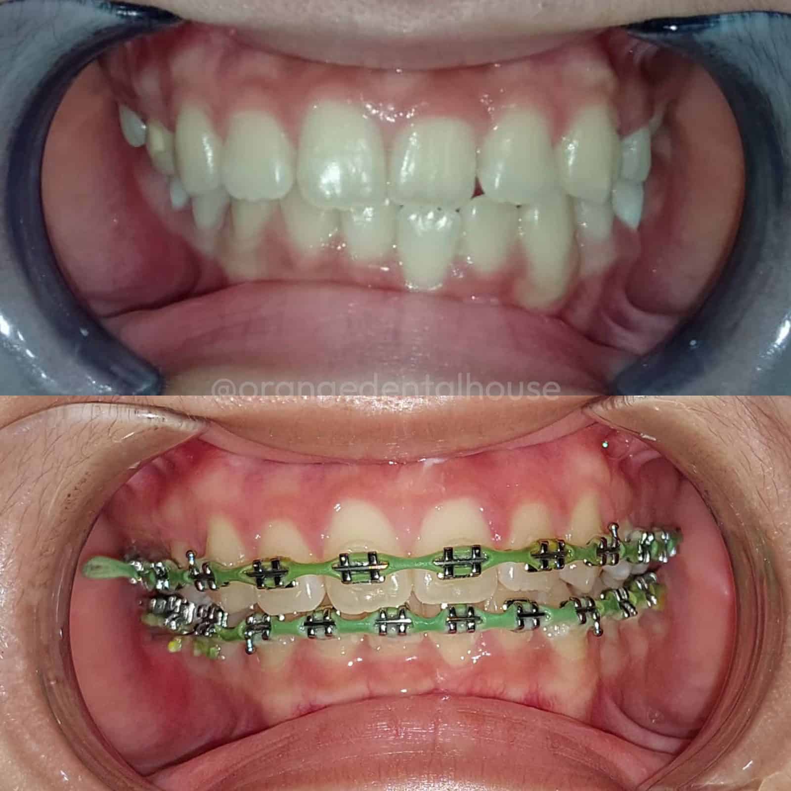Behel Gigi – Klinik Gigi Orange Dental