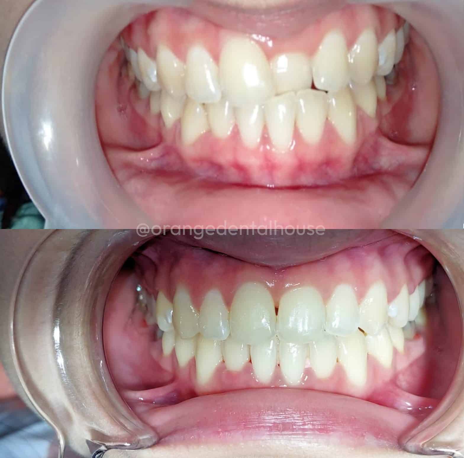 Behel Gigi - Orange Dental