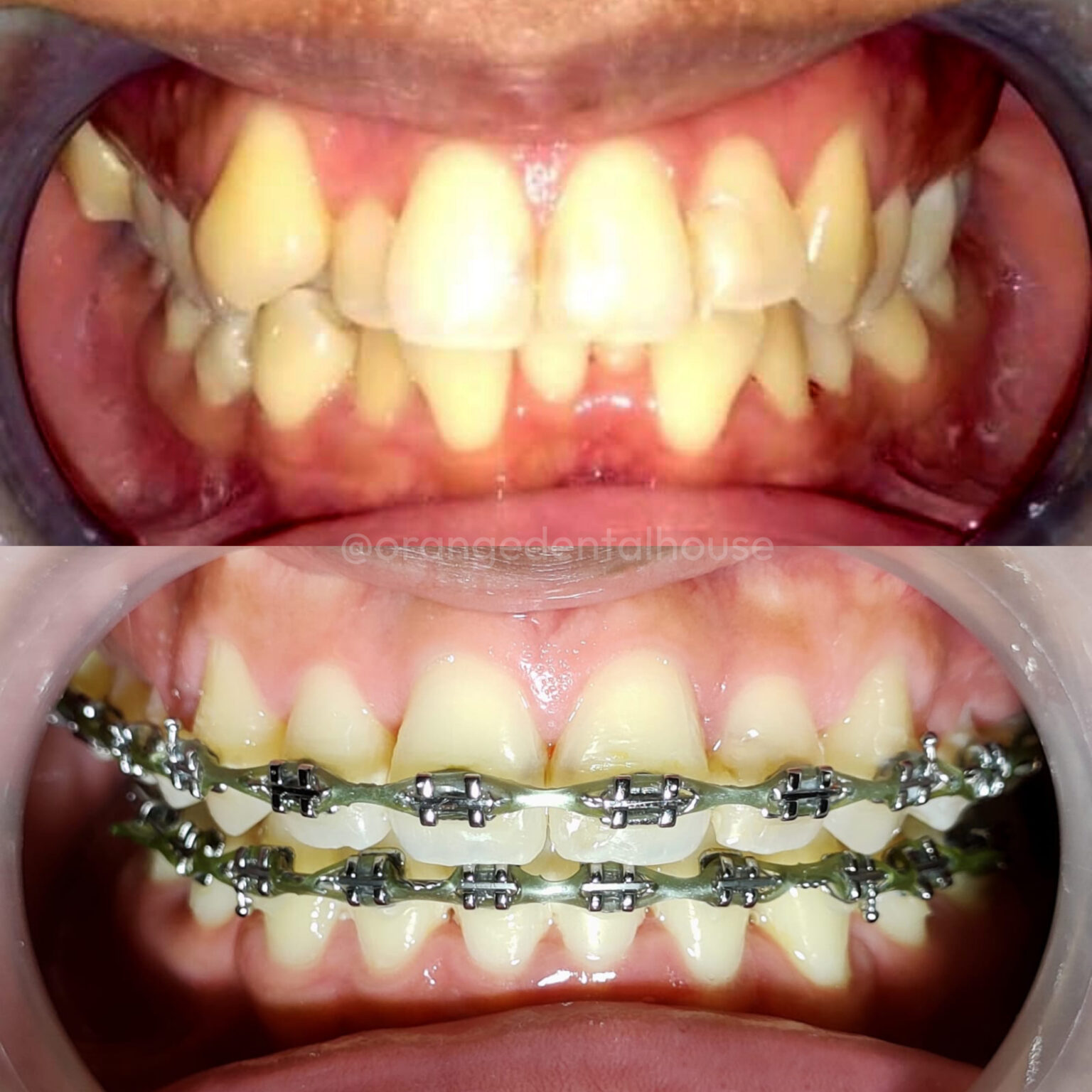 Behel Gigi - Orange Dental