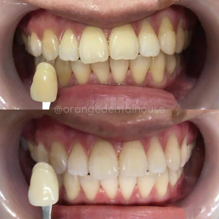 Bleaching – Klinik Gigi Orange Dental