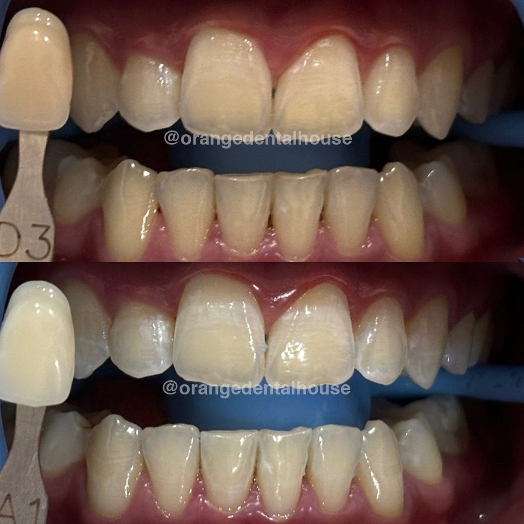 Bleaching – Klinik Gigi Orange Dental