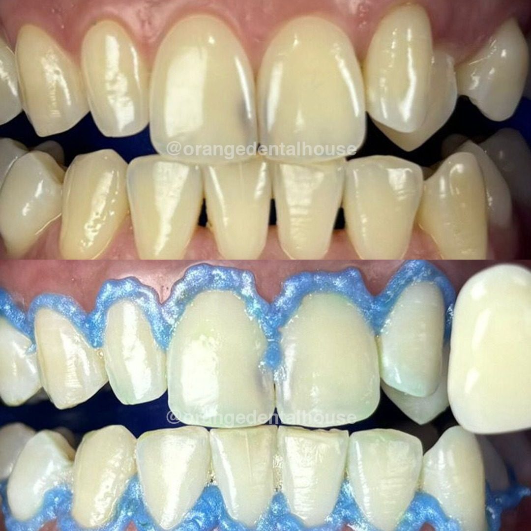 Bleaching – Klinik Gigi Orange Dental